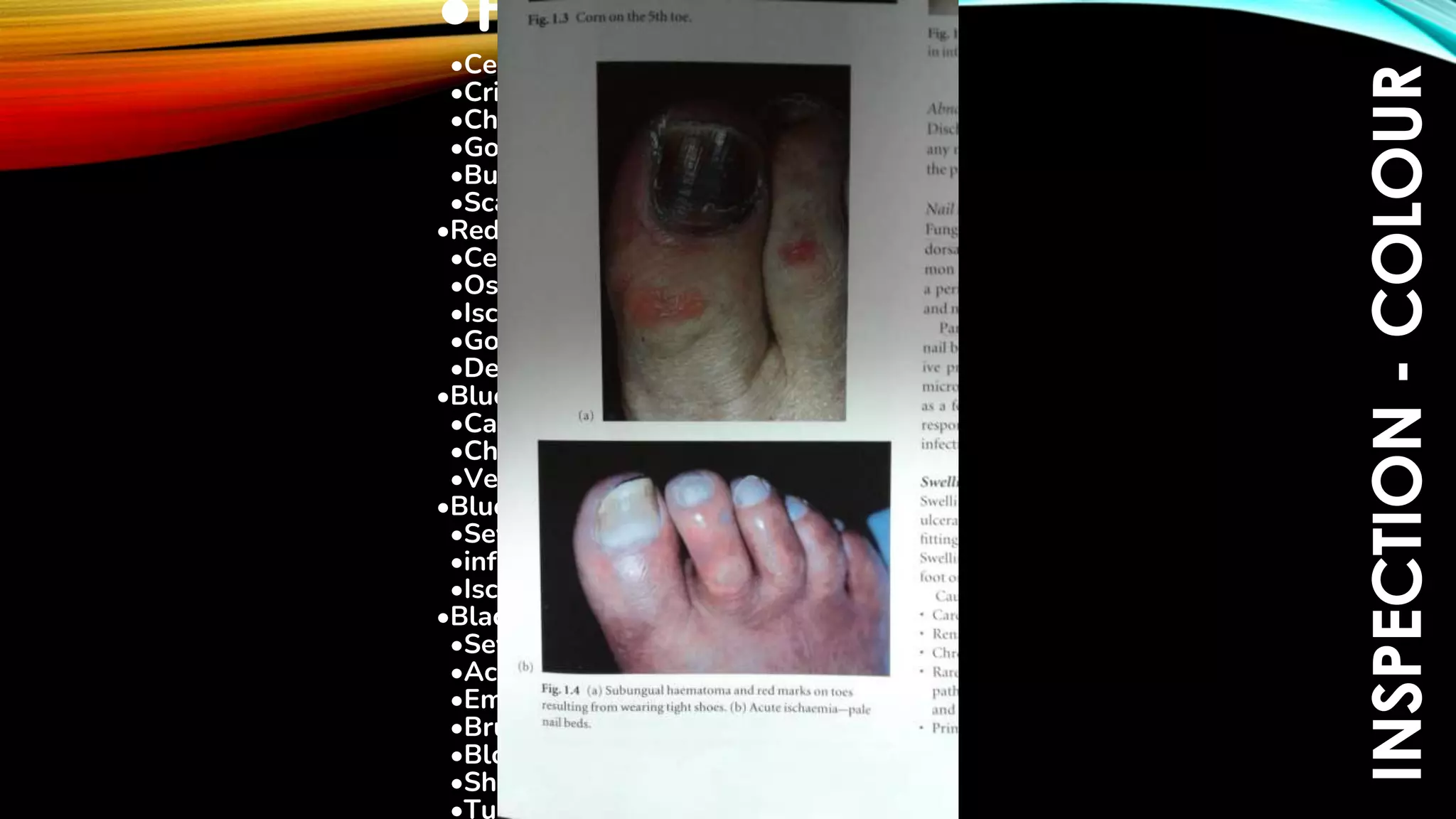 DIABETIC FOOT & STI seminar.pptx