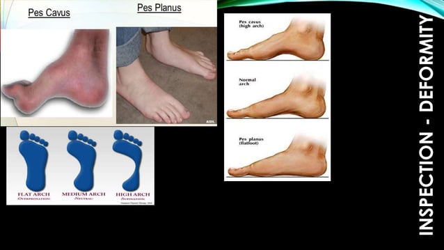DIABETIC FOOT & STI seminar.pptx