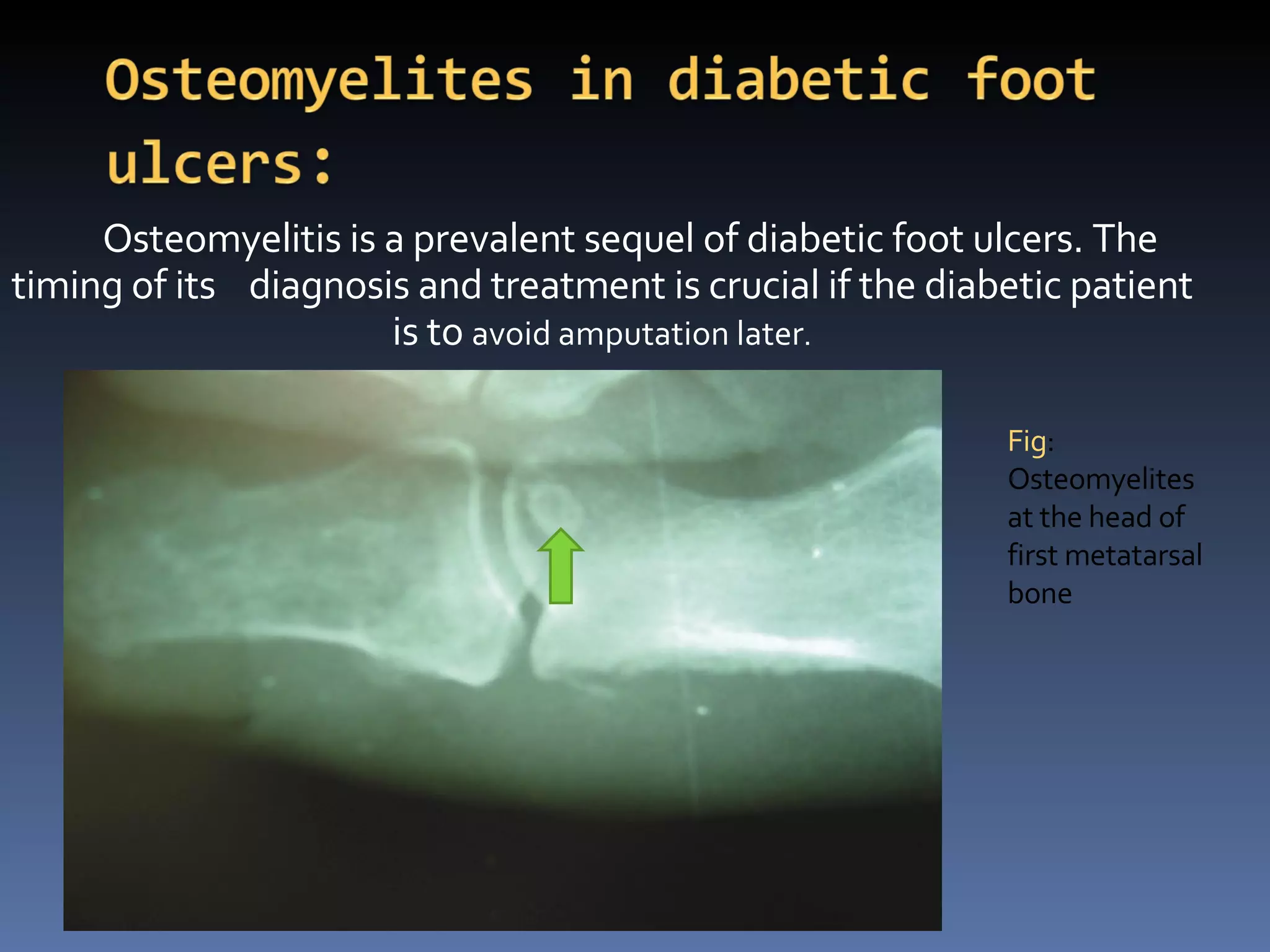 Diabetic Foot Ulcer | PPT