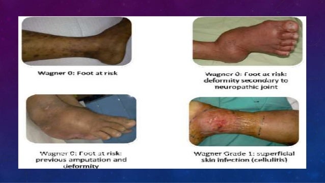 Wagner Stages Of Ulcers | How To Grade Diabetic Foot Ulcer – WOLMDE