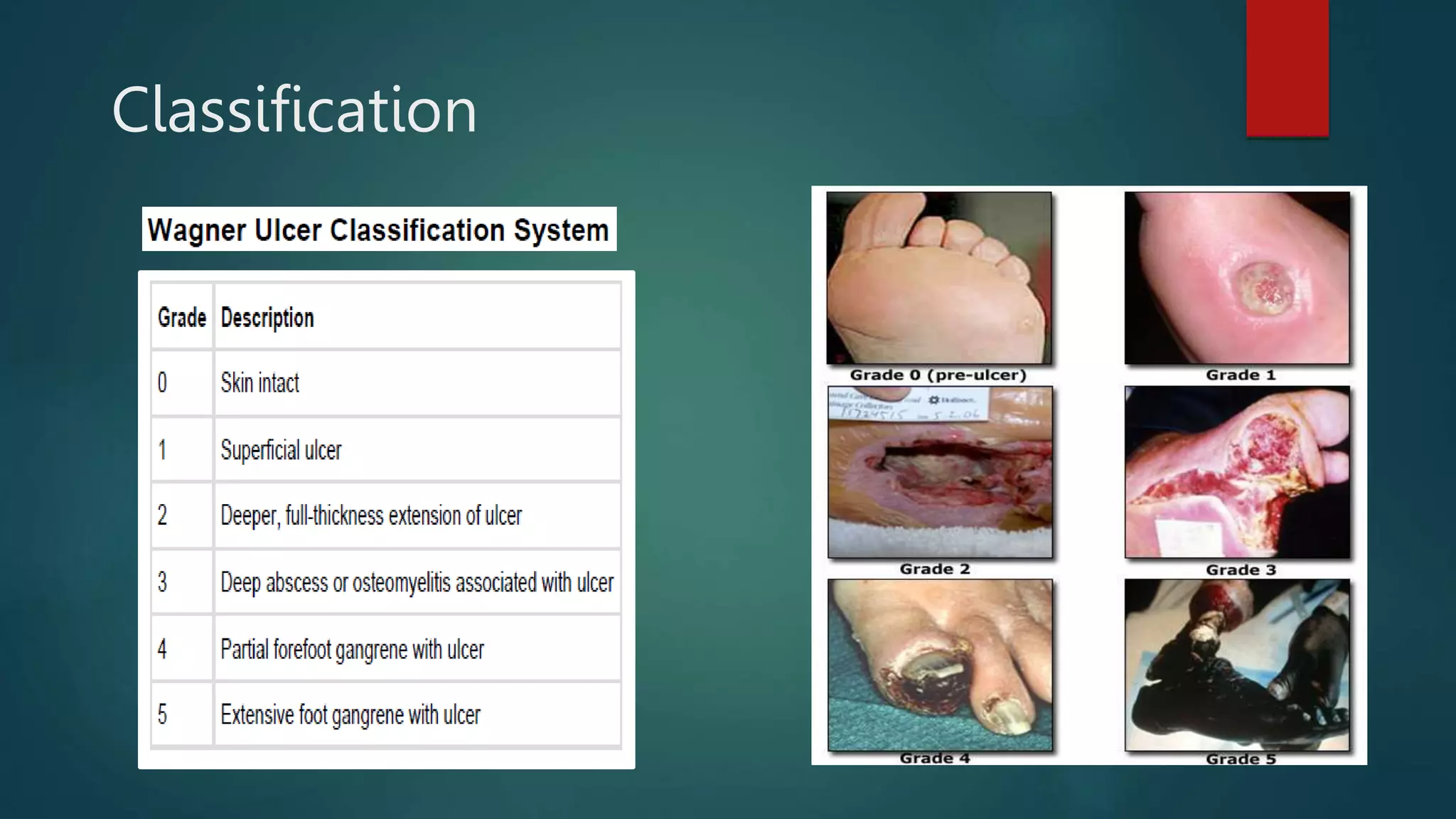 Diabetic Foot Ulcer.pptx