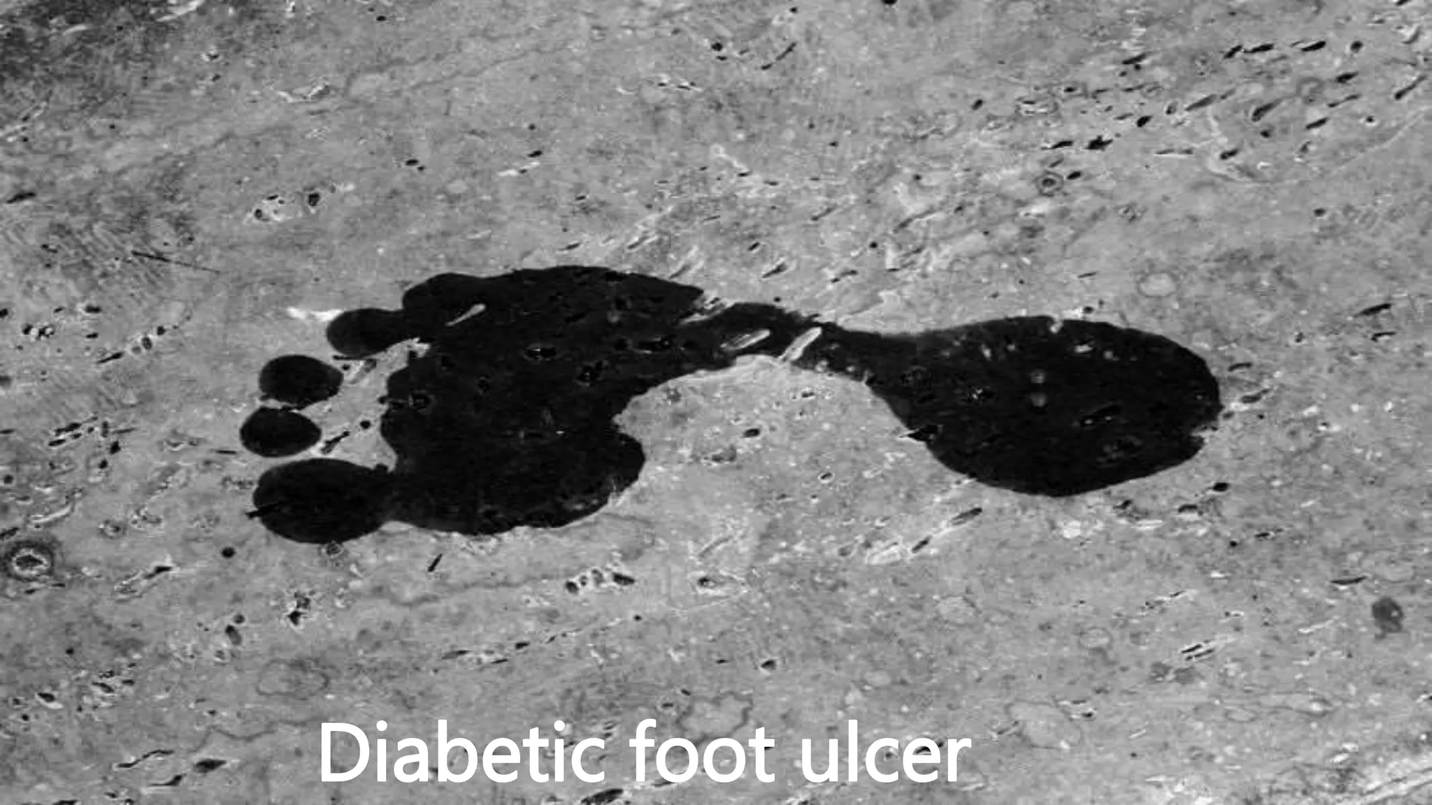 Diabetic Foot Ulcer Classification Management Pptx