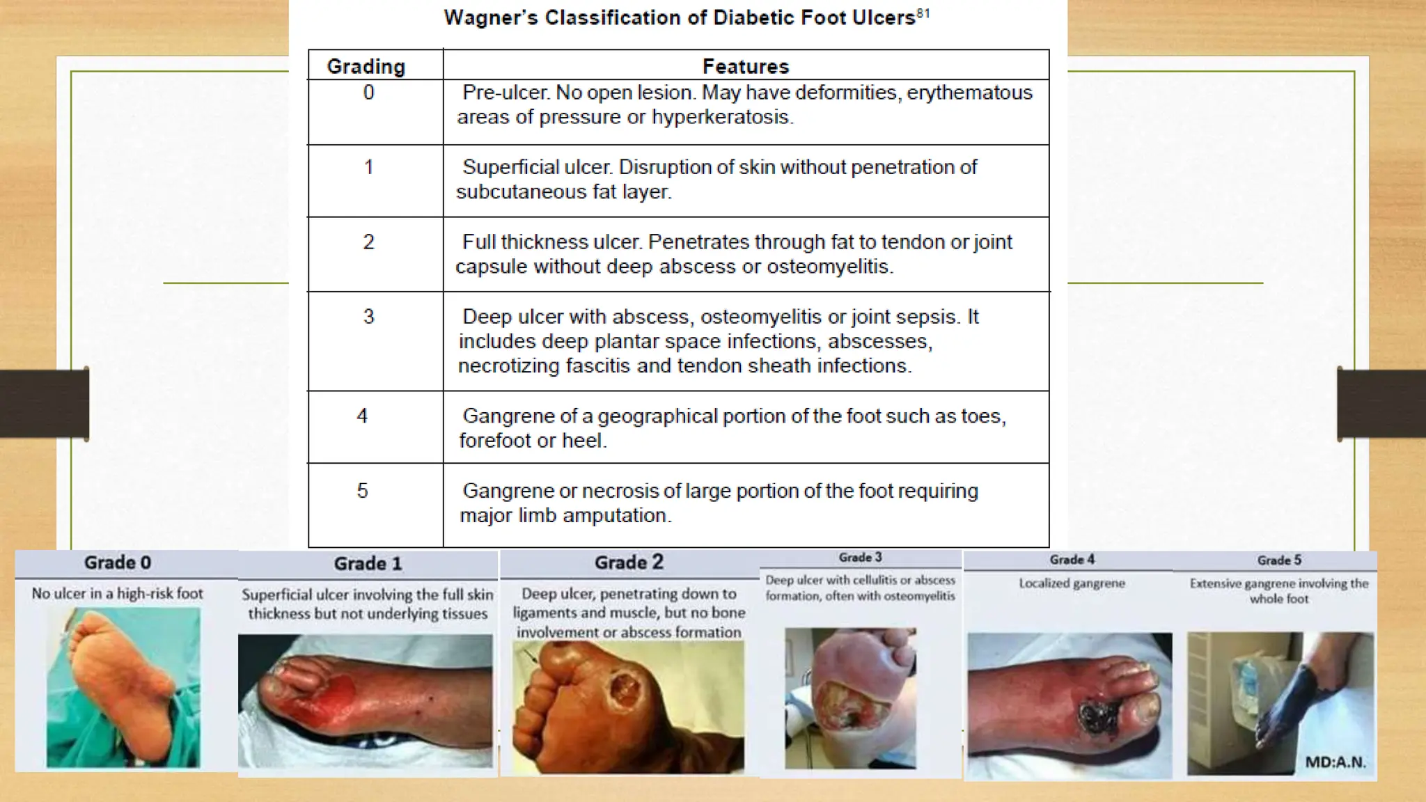 diabetic foot ulcer classification management .pptx