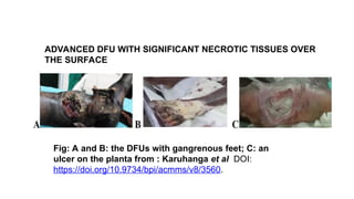 DIABETIC FOOT ULCER.ppt PATHOPHYSIOLOGY. | PPT