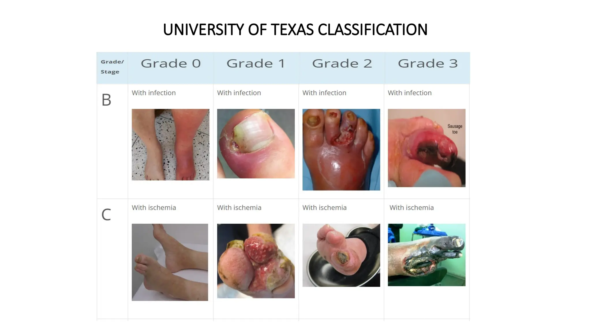 Diabetic Foot Ulcer Classification System - Texa s and Wagner.pptx