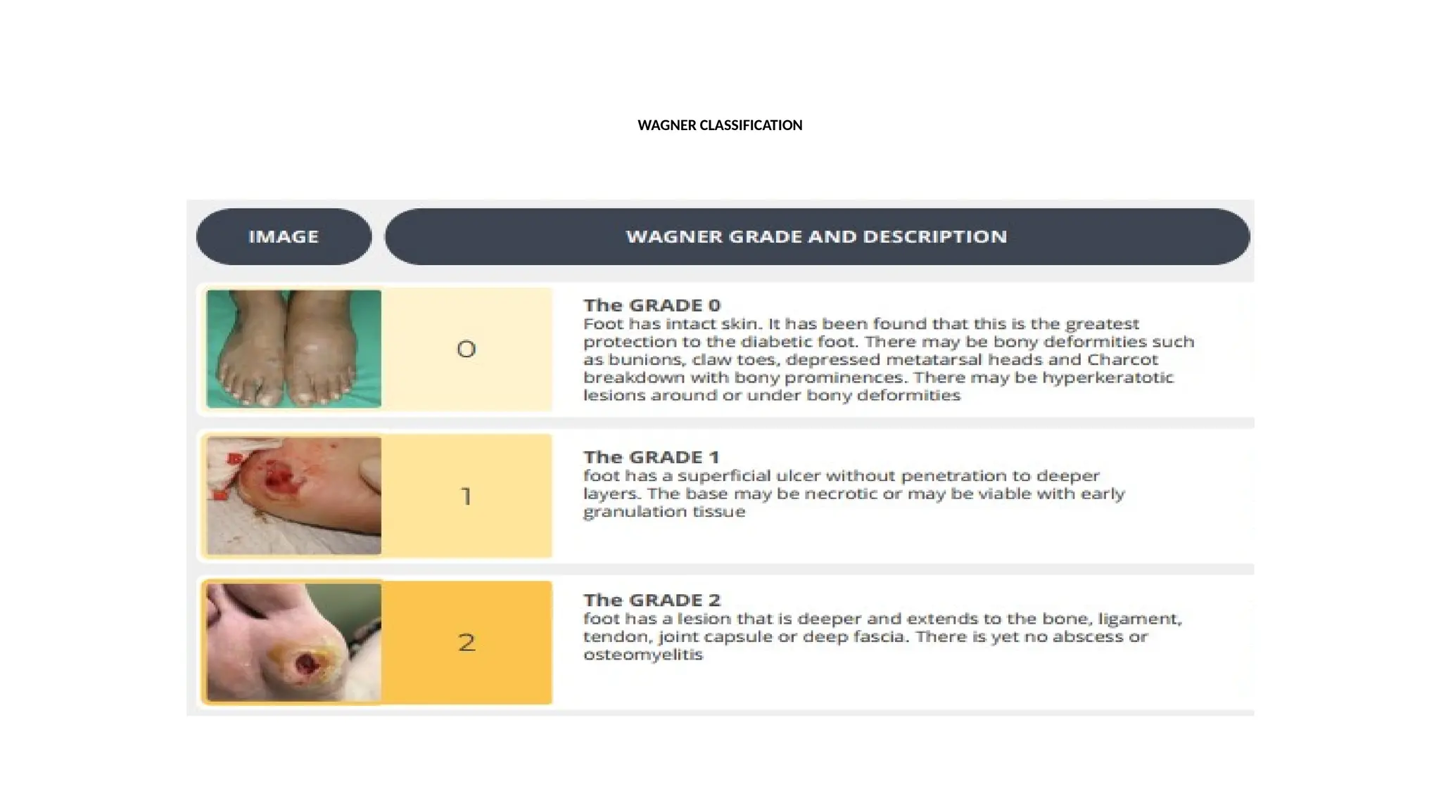 Diabetic Foot Ulcer Classification System - Texa s and Wagner.pptx