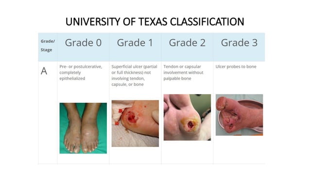 Diabetic Foot Ulcer Classification System - Texa s and Wagner.pptx