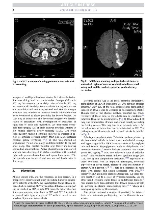 Diabetic ketoacidosis induced cerebral infarct - A missing link in ...