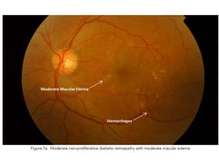 Diabetic macula edema | PPTX