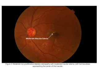 Diabetic macula edema | PPTX