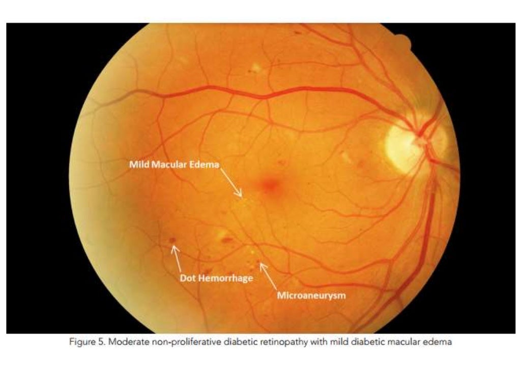 Diabetic macula edema