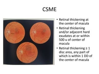 Diabetic Macular Edema | PPT