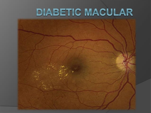 Diabetic macular edema | PPTX | Eye and Vision Conditions | Diseases ...