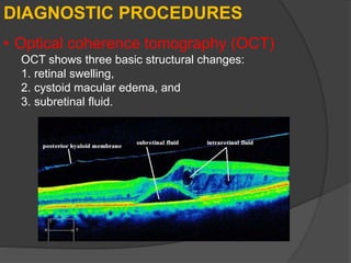Diabetic macular edema | PPTX