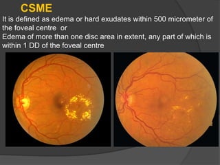 Diabetic macular edema | PPTX