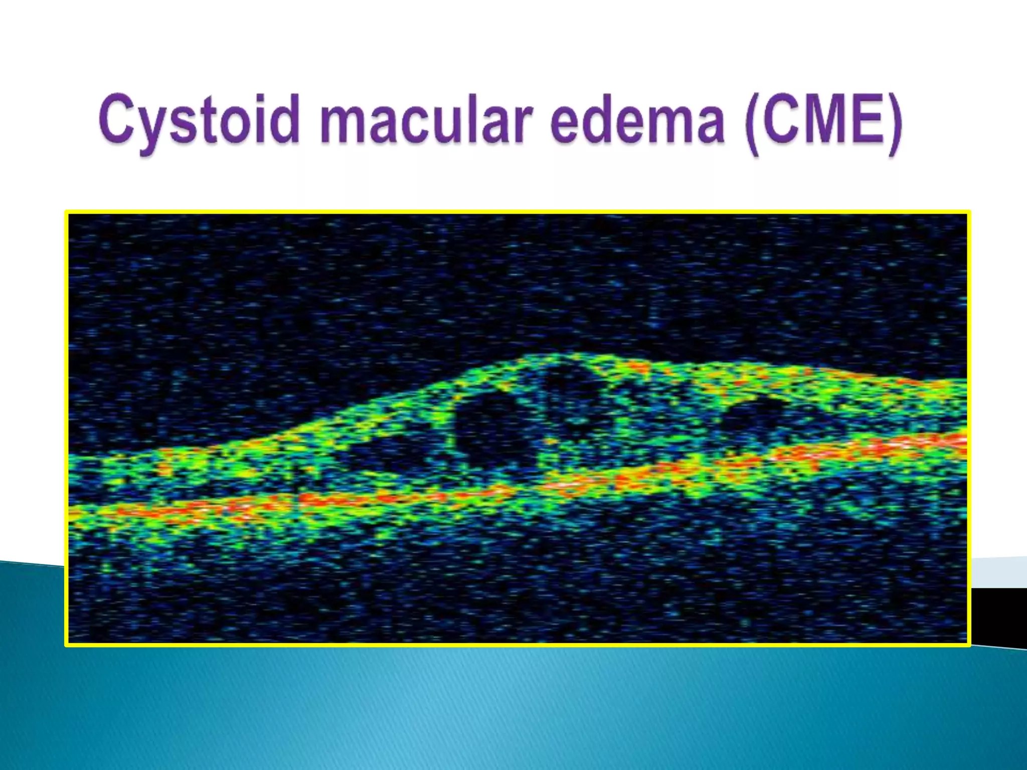 Diabetic macular edema | PPTX
