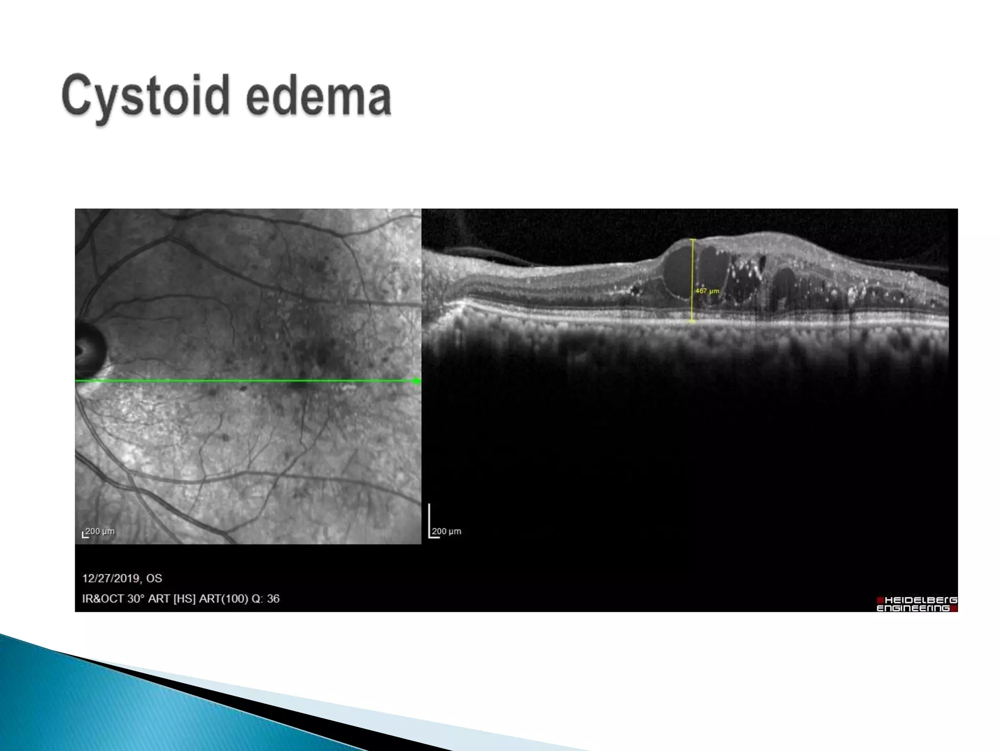 Diabetic macular edema | PPTX