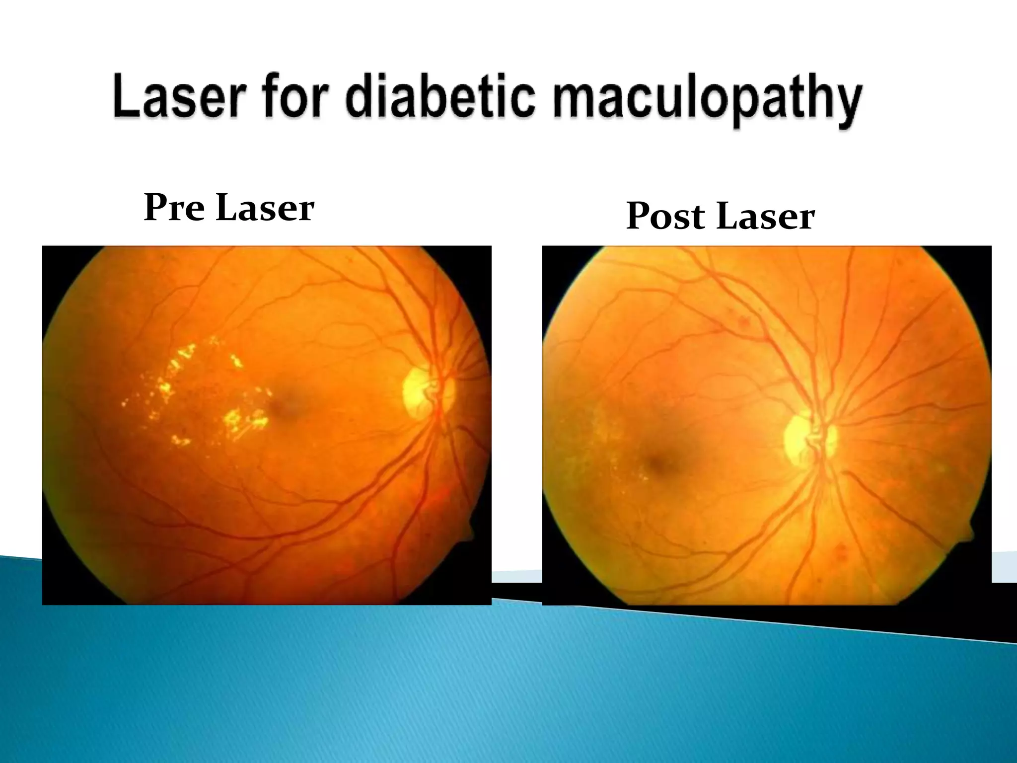 Diabetic macular edema | PPTX