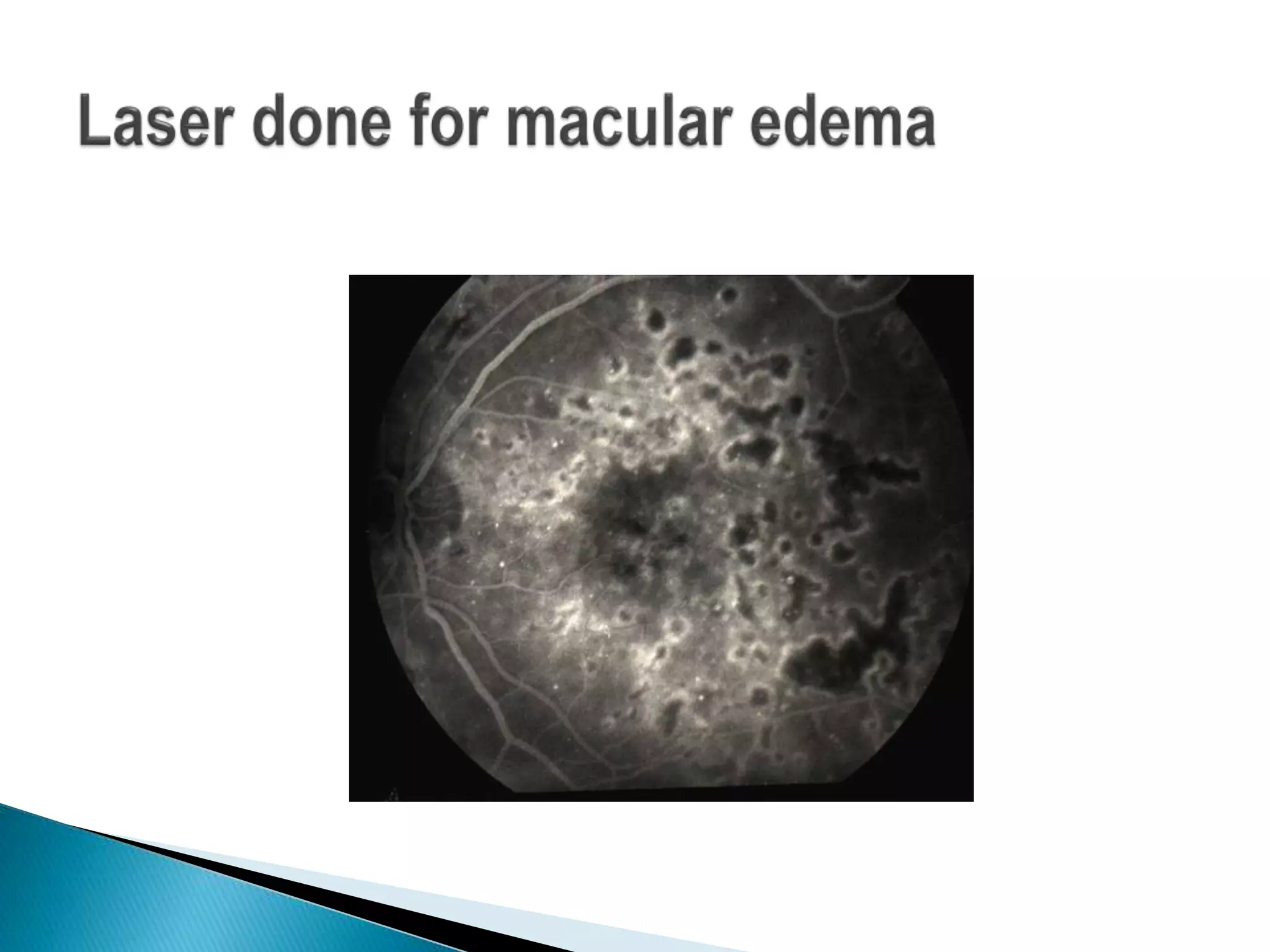 Diabetic macular edema | PPTX