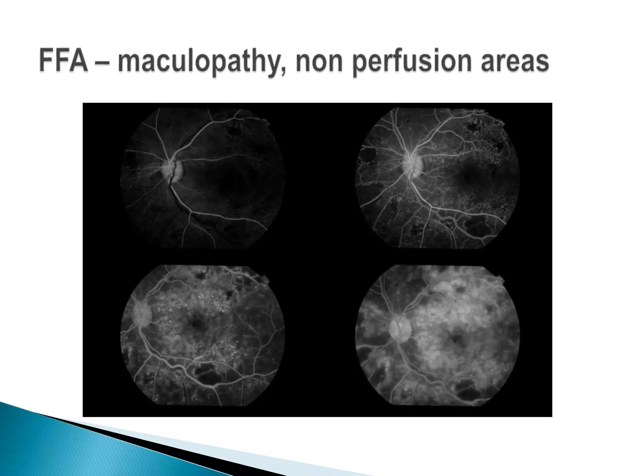 Diabetic macular edema | PPTX