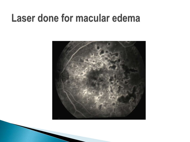 Diabetic macular edema | PPTX | Eye and Vision Conditions | Diseases ...