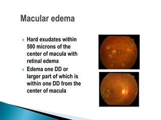 Diabetic macular edema | PPTX