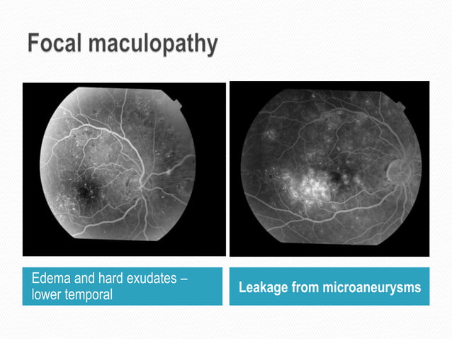 Diabetic macular edema | PPTX | Eye and Vision Conditions | Diseases ...