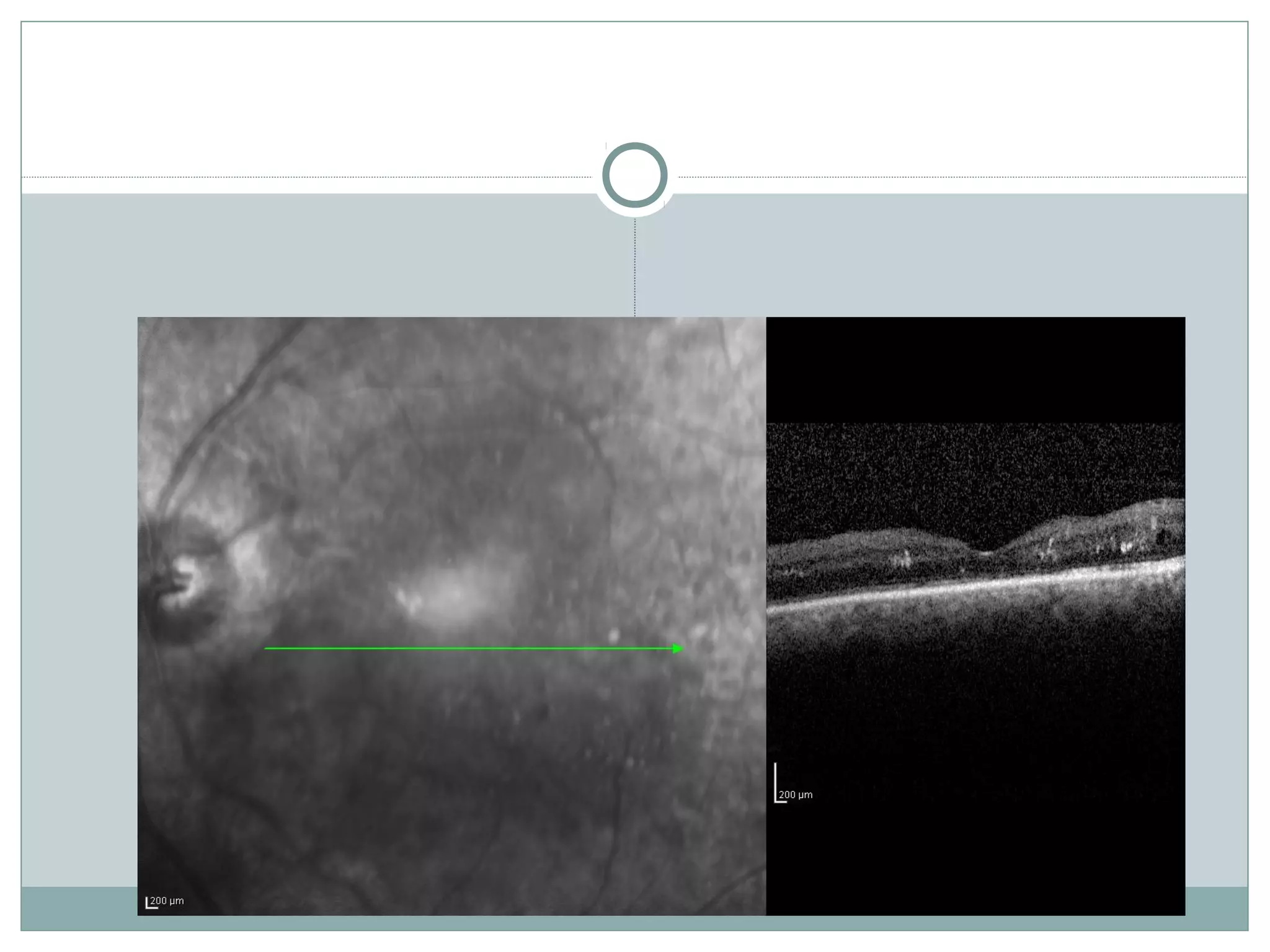 Diabetic Maculopathy | PPT