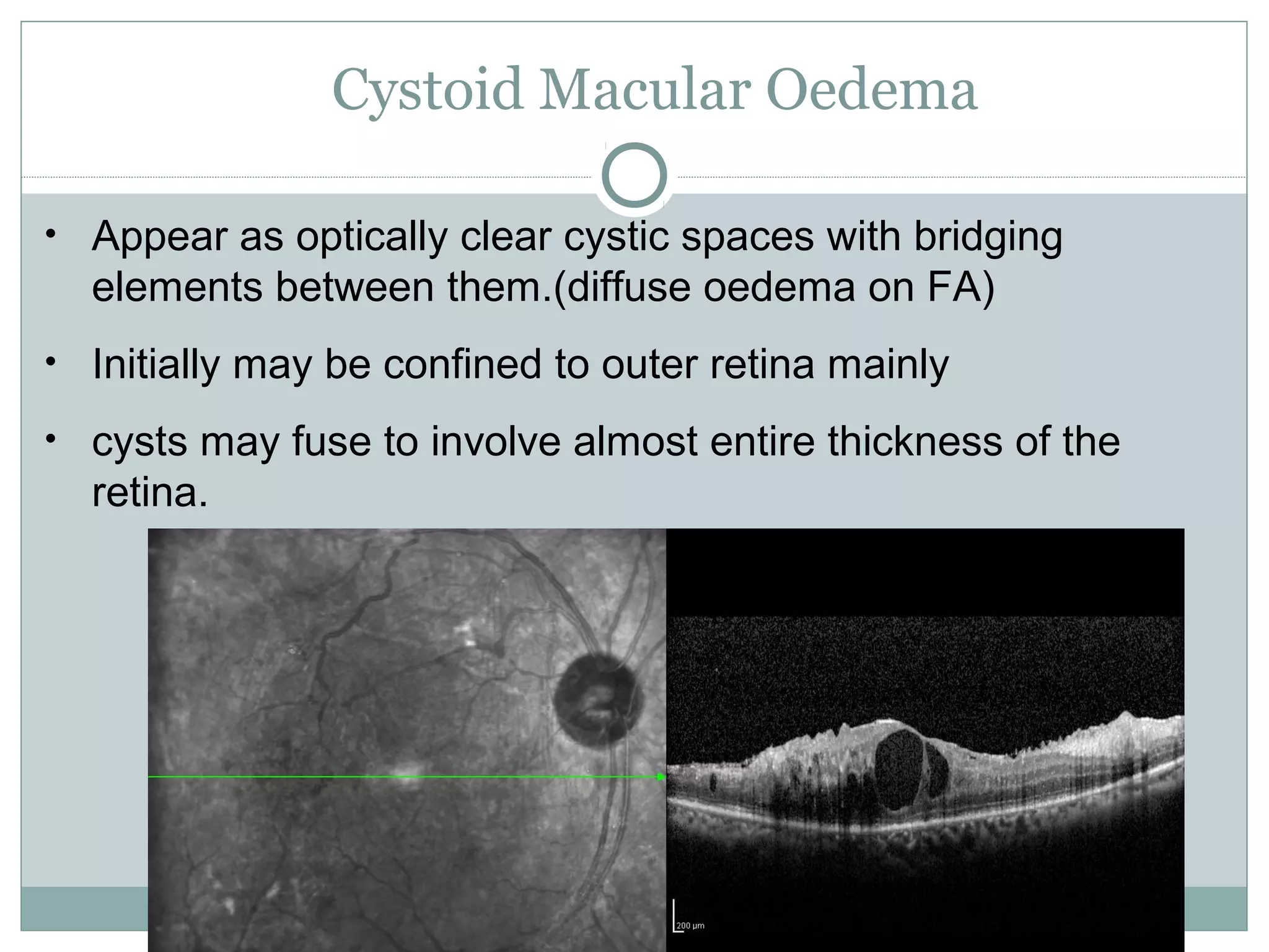 Diabetic Maculopathy | PPT