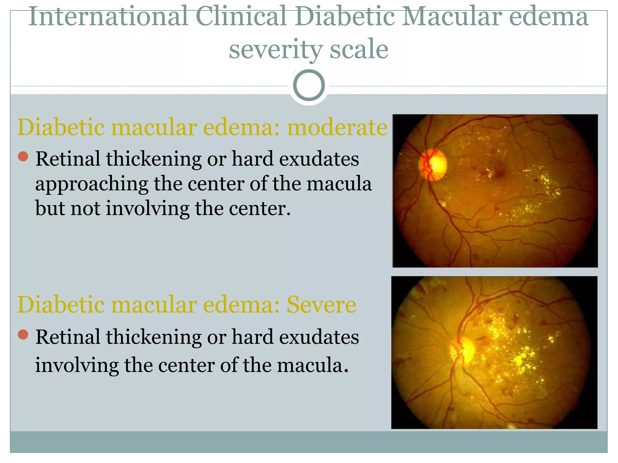 Diabetic Maculopathy | PPT