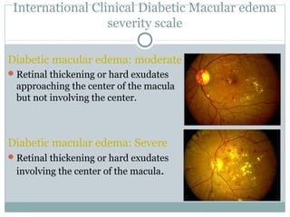 Diabetic Maculopathy