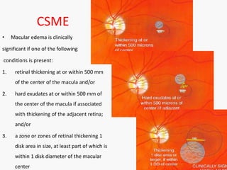 Diabetic macular edema | PPTX