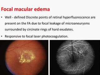 Diabetic macular edema | PPTX