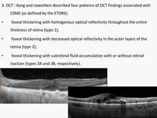 Clinically Significant Macular Edema Oct