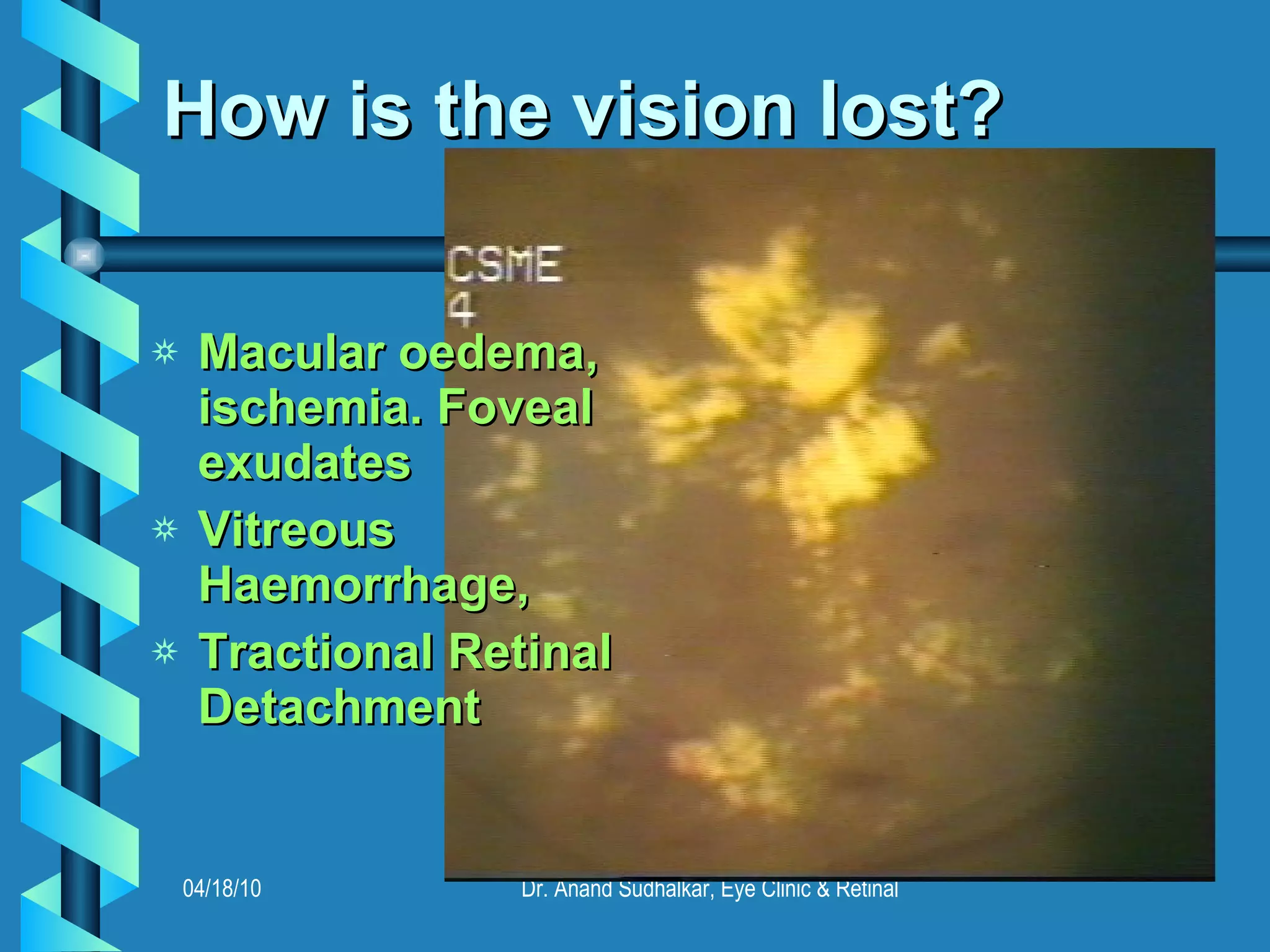 Diabetic Maculopathy1 Gos2 | PPT