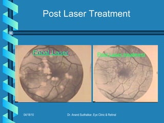 Diabetic Maculopathy1 Gos2 | PPT