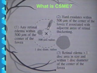 Diabetic Maculopathy1 Gos2 | PPT