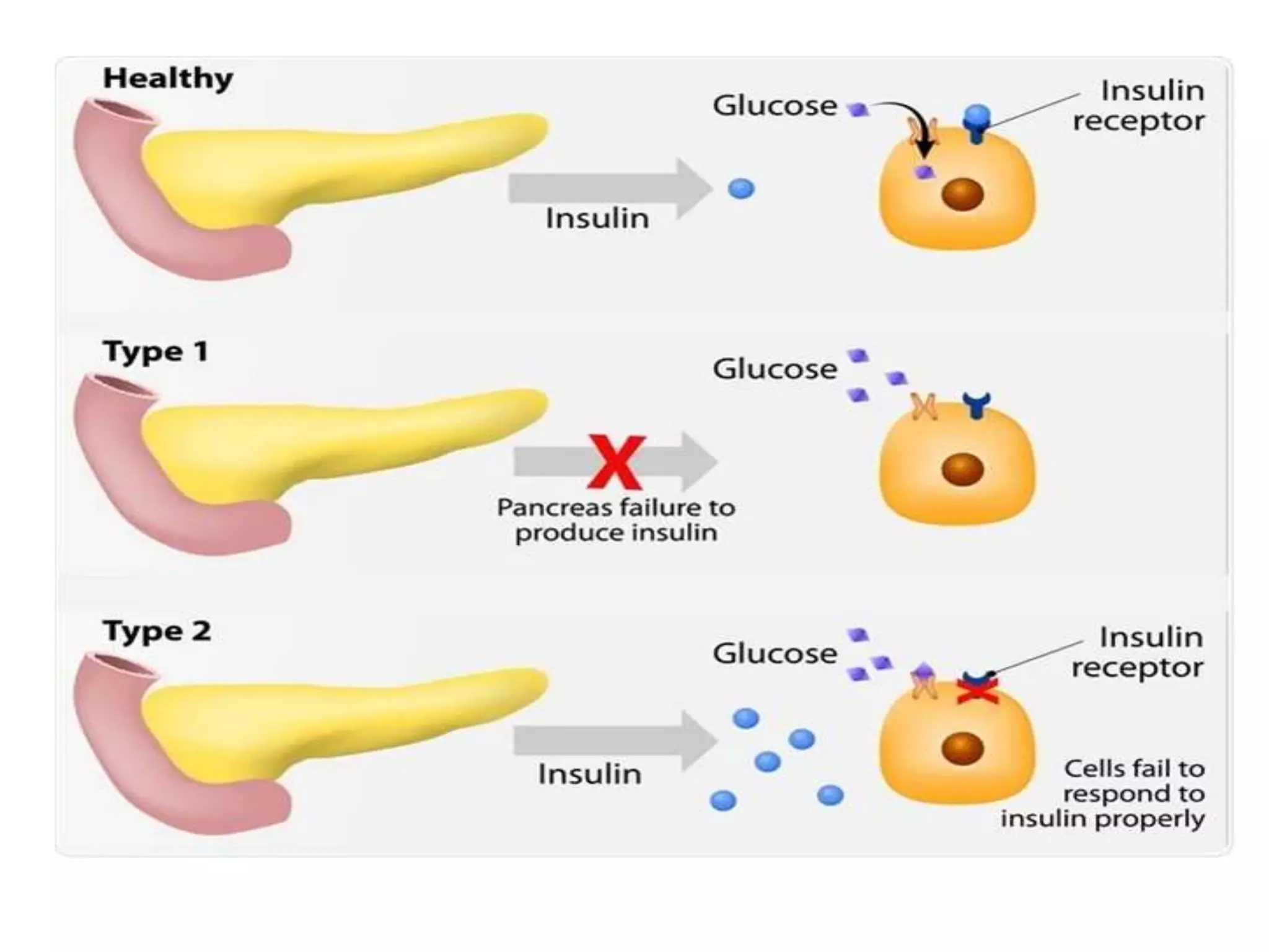 Diabetic mellitus pathophysiology | PPTX