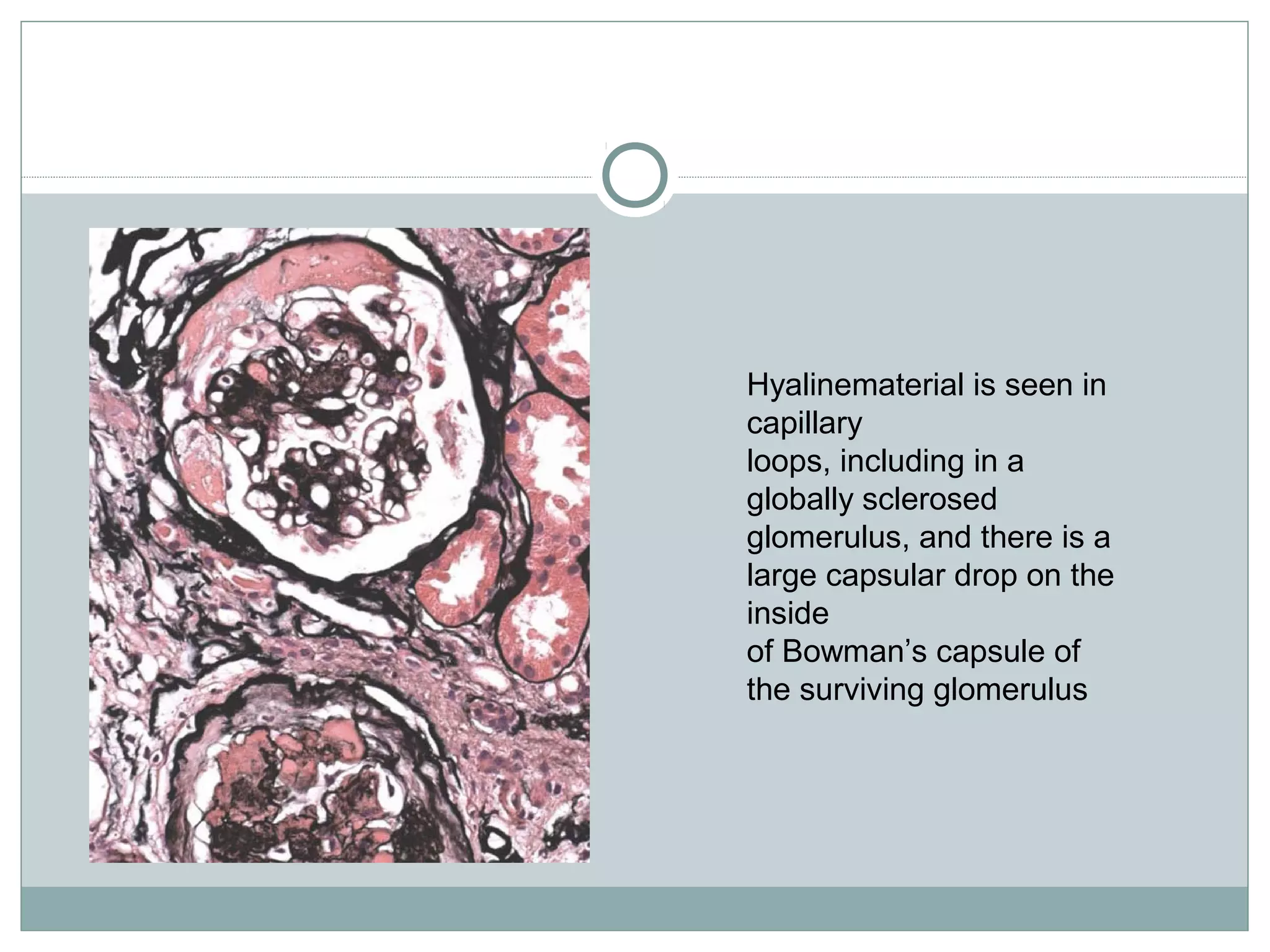 Diabetic nephropathy | PPT | Chemistry | Science