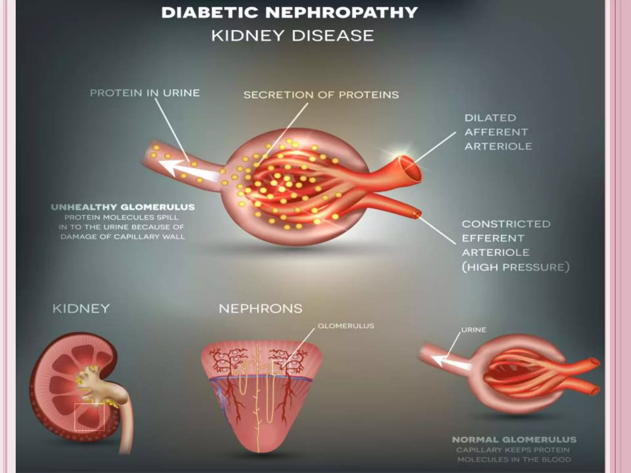 Diabetic nephropathy | PPT