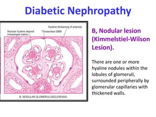 Diabetic nephropathy | PPTX