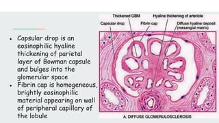 DIABETIC NEPHROPATHY for MBBS STUDENT.pptx | Diabetes | Diseases and ...