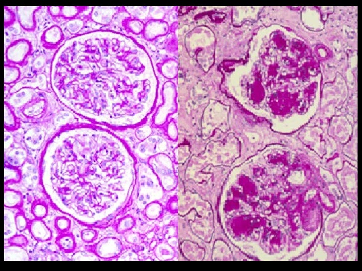 Nephropathy Diabetic Nephropathy Pathology