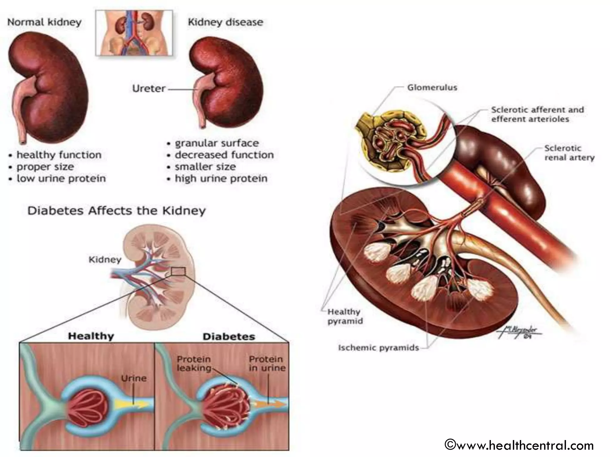 Diabetic nephropathy v7 | PPT