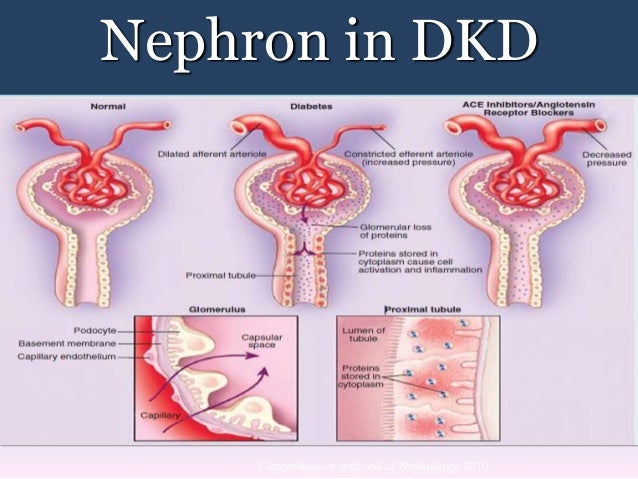 Diabetic nephropathy why and why not