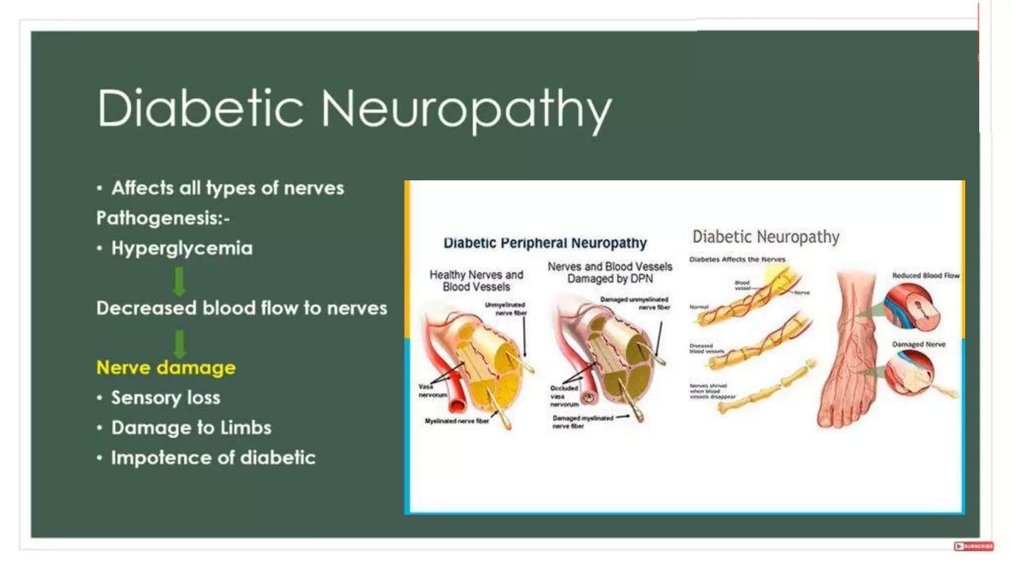 Diabetic neuropathy.pptx