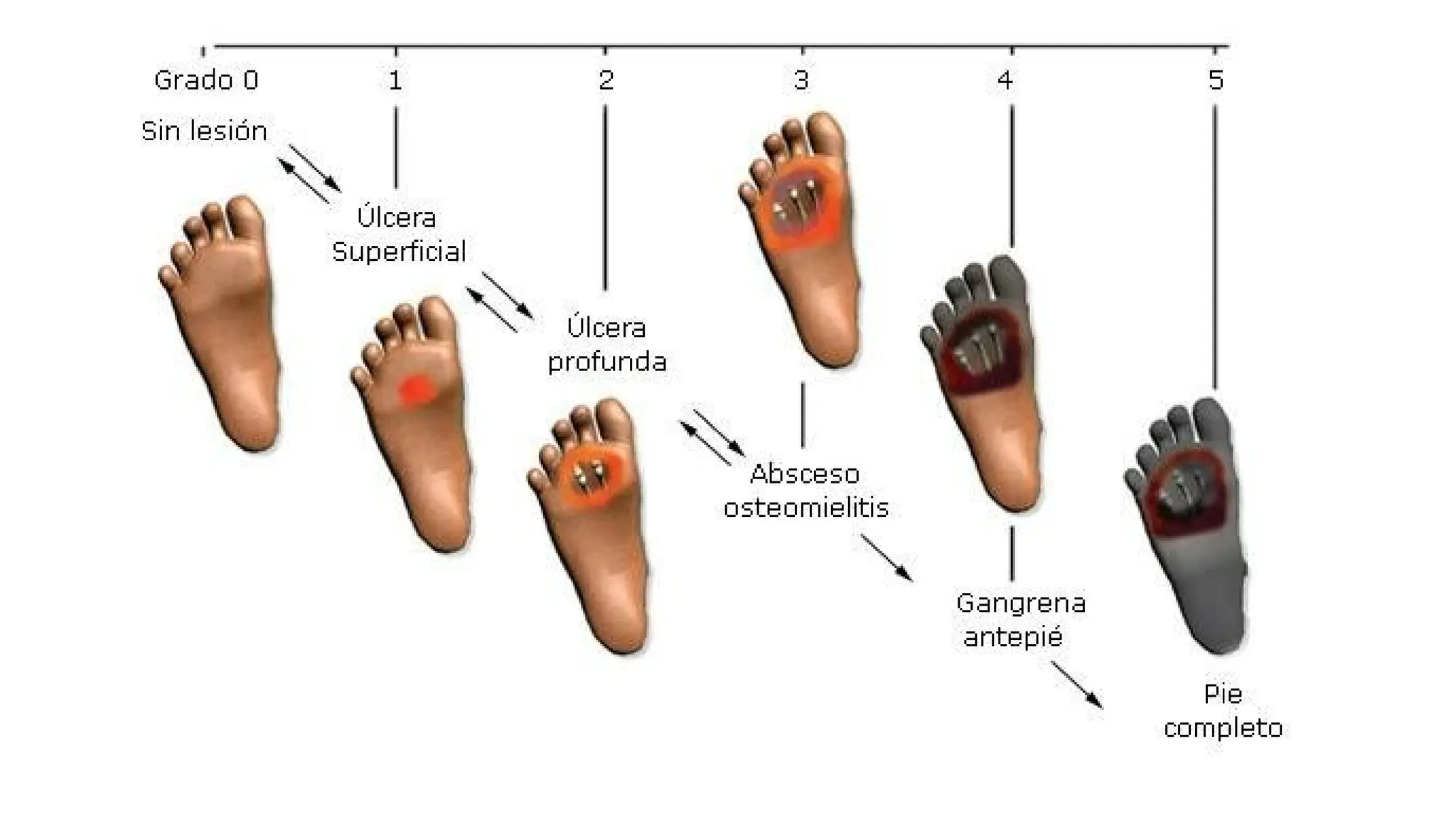 pie diabetico, clasificacion de wagner pptx | PPTX