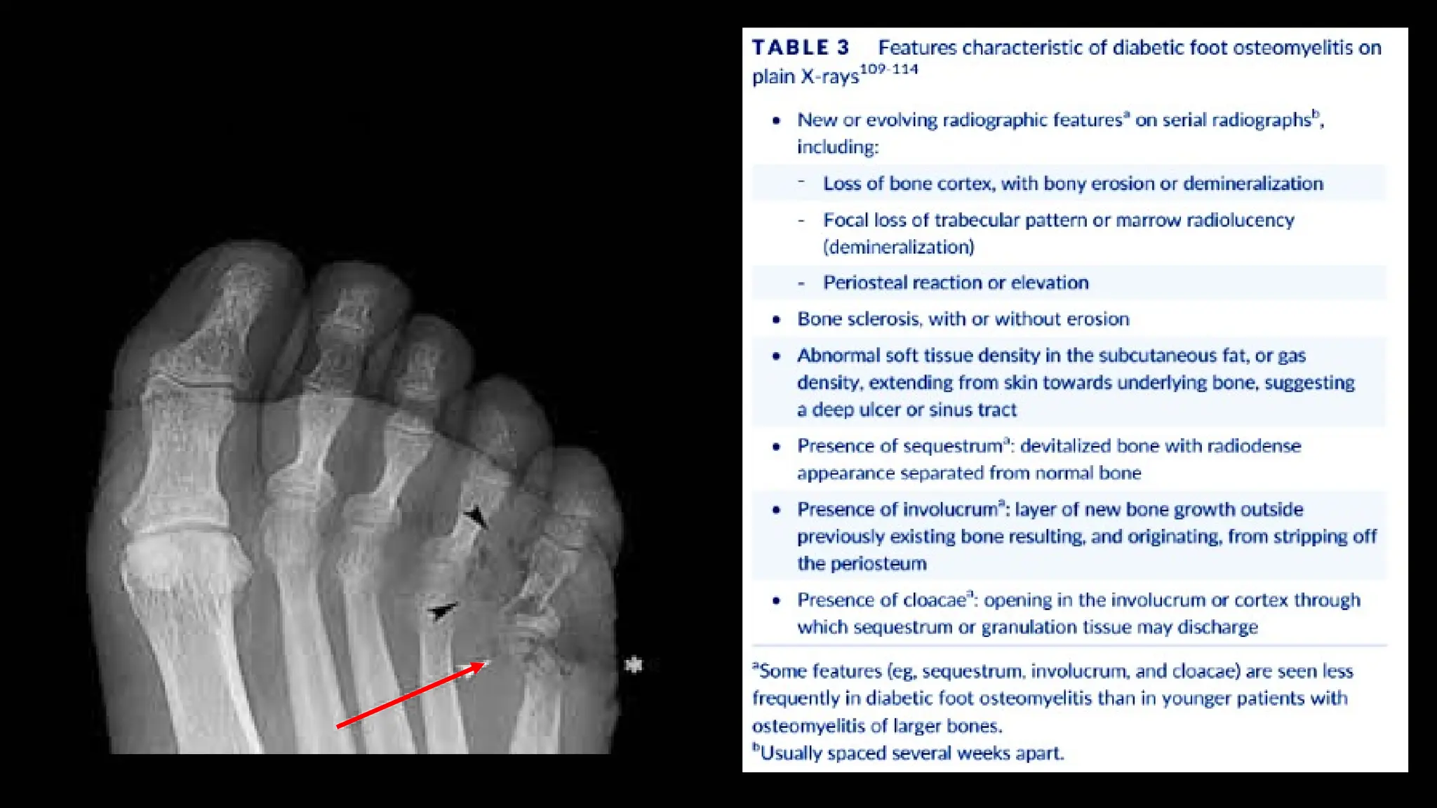 pie diabetico, clasificacion de wagner pptx | PPTX