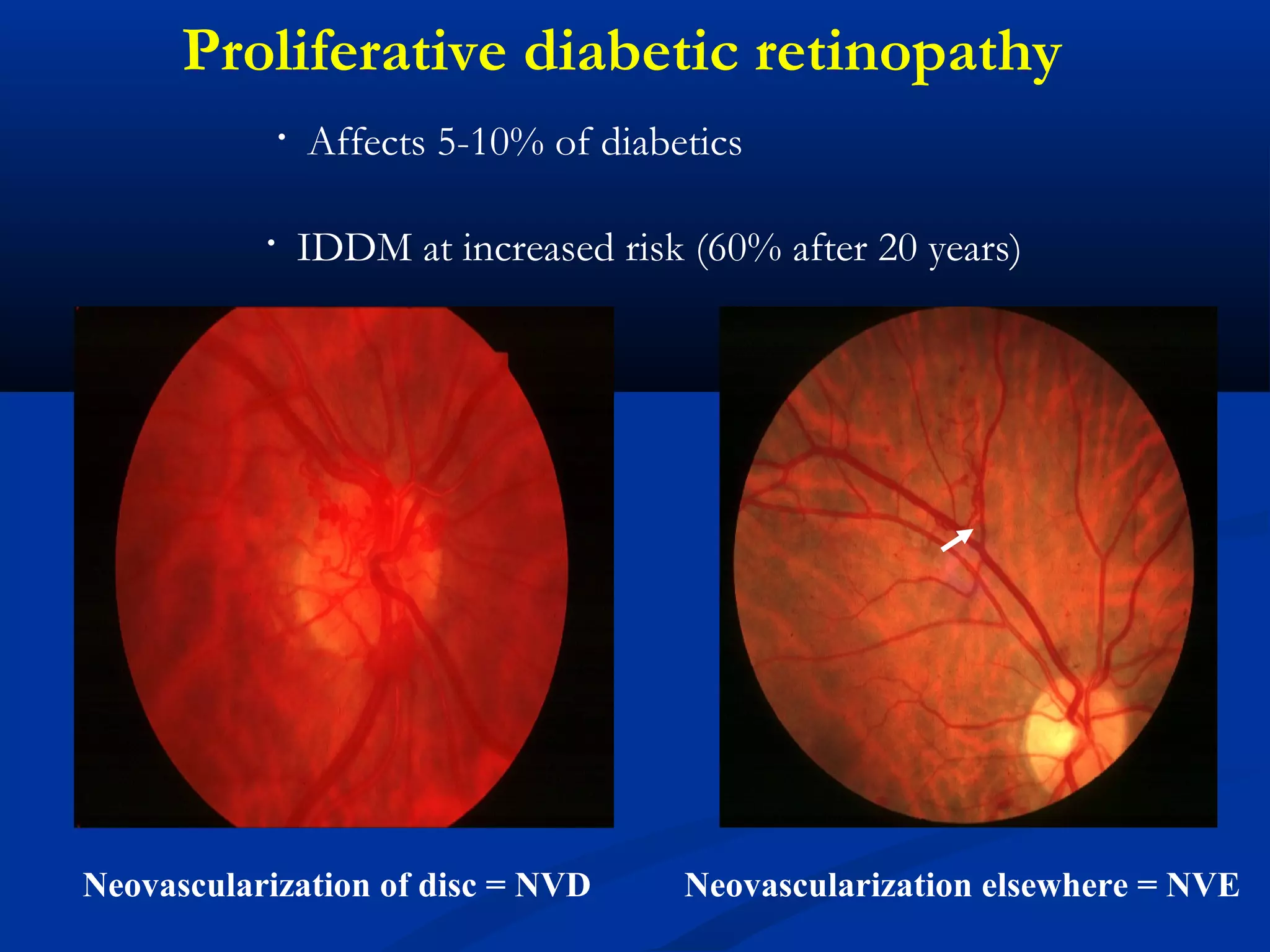 Diabetic ophthalmopathy | PPT