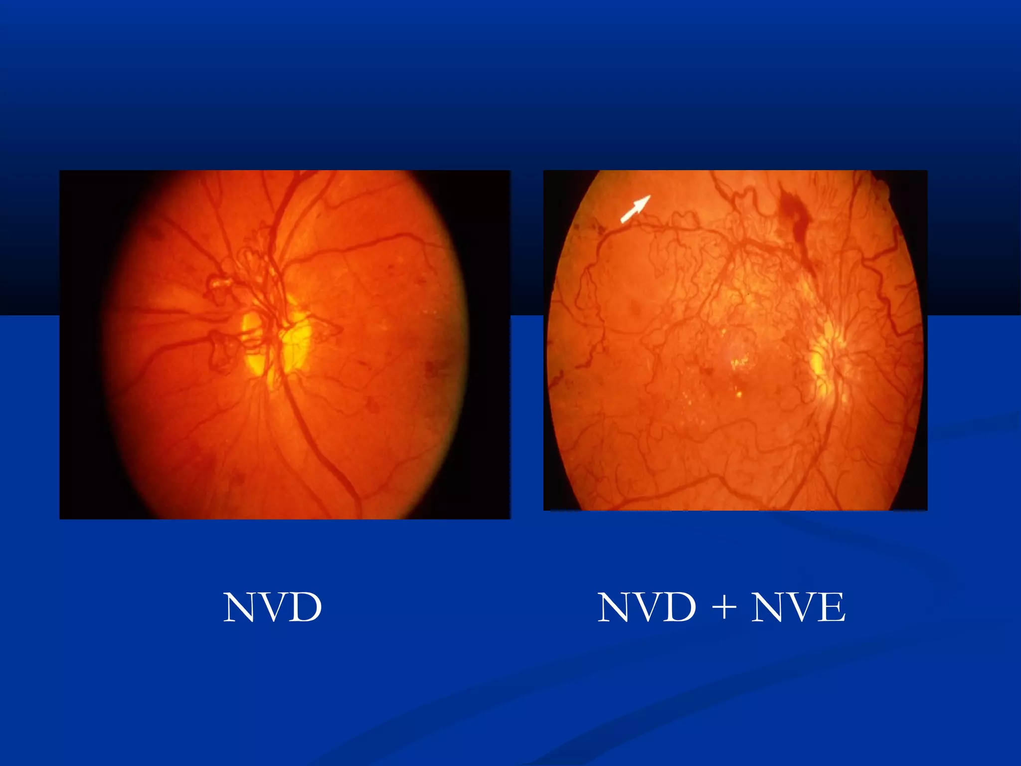 Diabetic ophthalmopathy | PPT